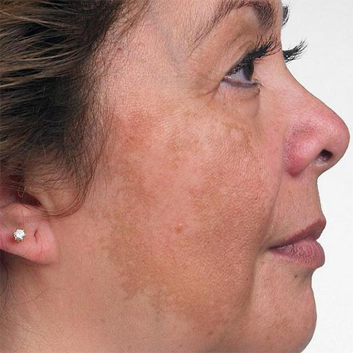 PIGMENTATION / DARK SPOTS